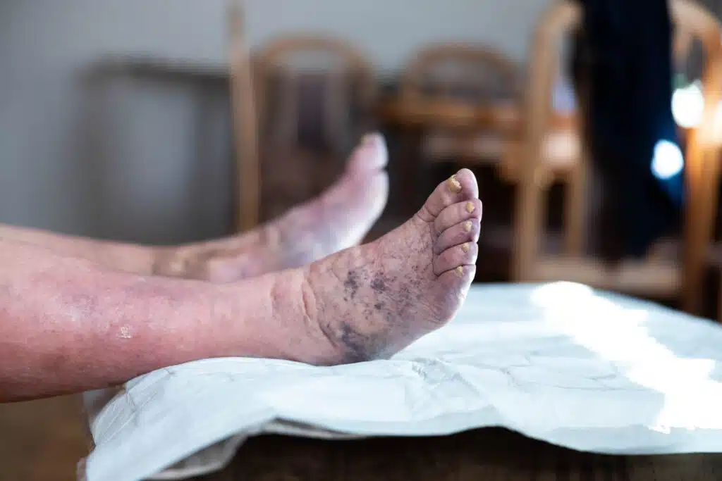 Leg Discoloration: Causes, Symptoms & Treatment
